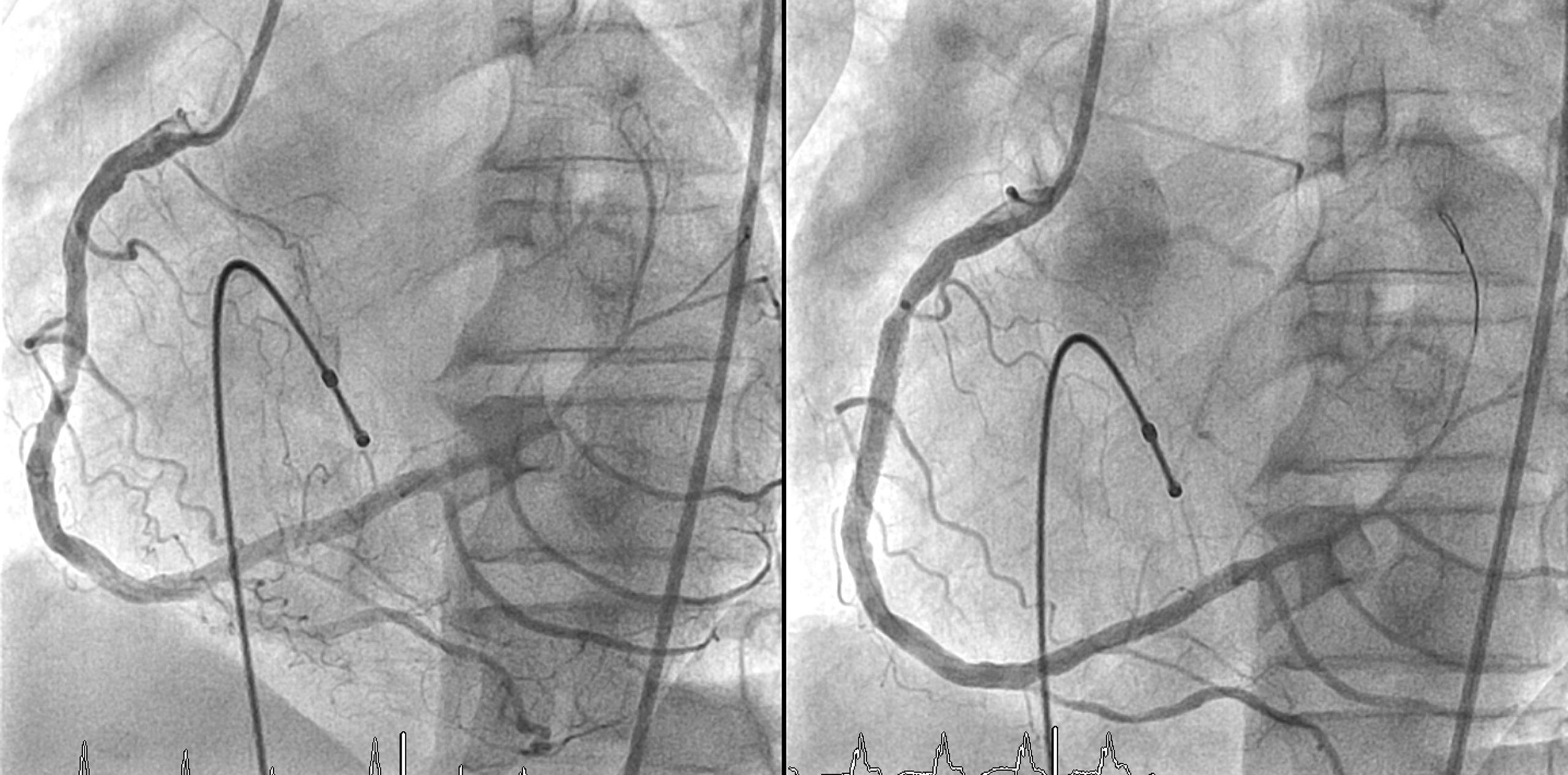 CURRENT PCI DATABASE - British Cardiovascular Intervention Society