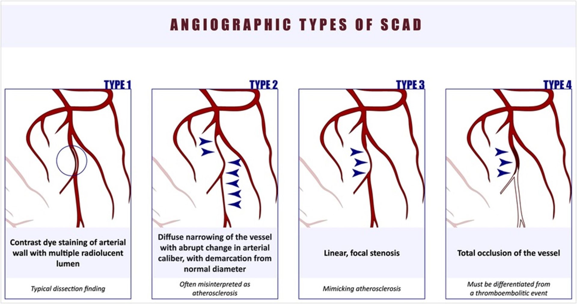 MANAGEMENT OF SCAD - British Cardiovascular Intervention Society