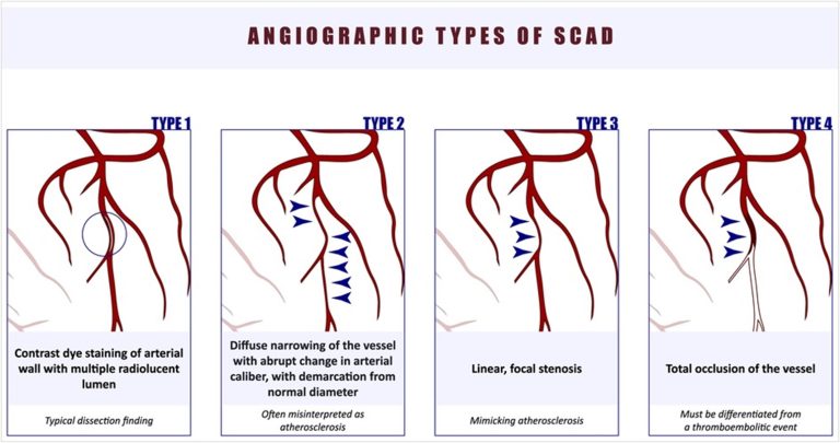 MANAGEMENT OF SCAD - British Cardiovascular Intervention Society
