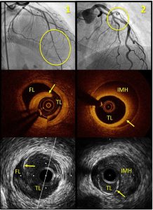 MANAGEMENT OF SCAD - British Cardiovascular Intervention Society