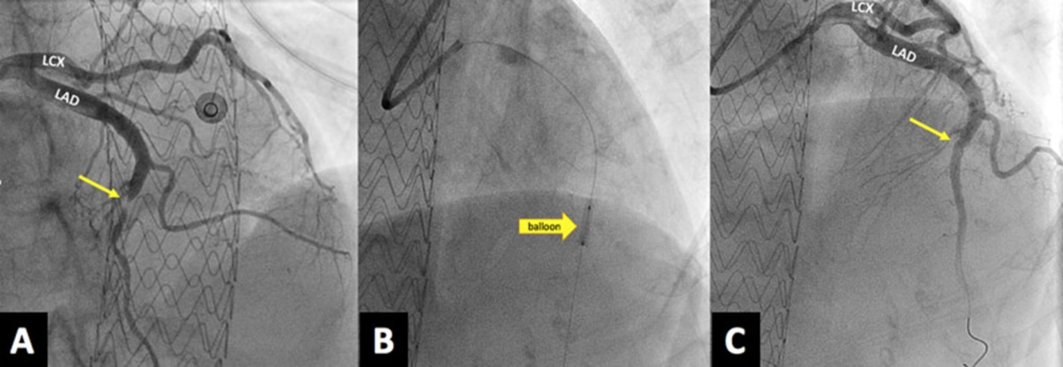MANAGEMENT OF SCAD - British Cardiovascular Intervention Society
